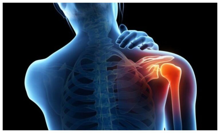 Qué es la capsulitis y cómo tratarla - Goniomedic - Granada